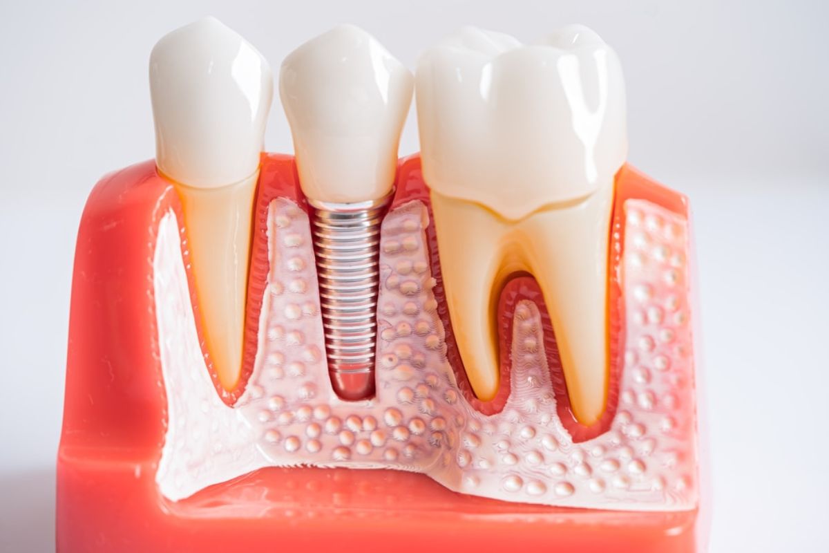Customized Implant Options For One Or Multiple Teeth